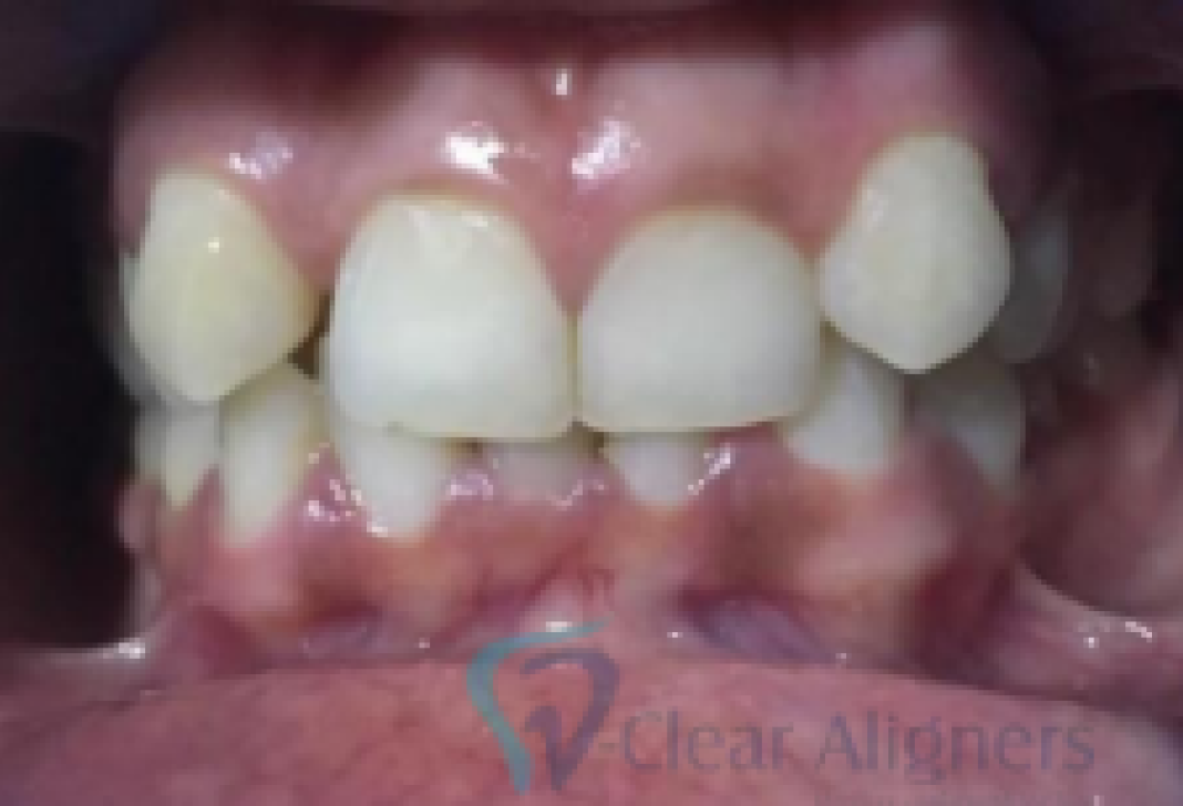 Case Studies - Invisible Dental Braces providers in Hyderabad - V Clear ...